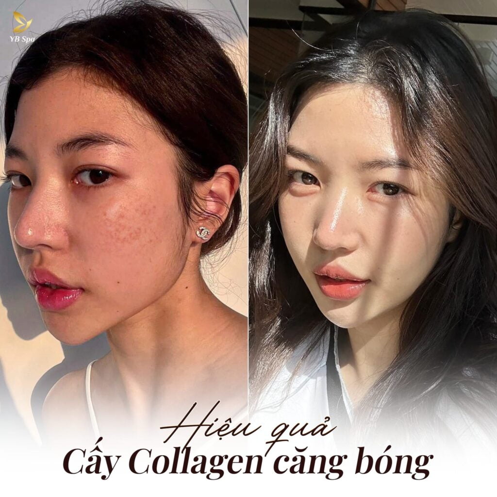 COLLAGEN CĂNG BÓNG - Viện Thẩm Mỹ YB Spa