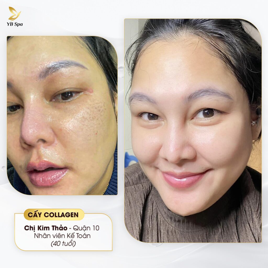 COLLAGEN CĂNG BÓNG - Viện Thẩm Mỹ YB Spa
