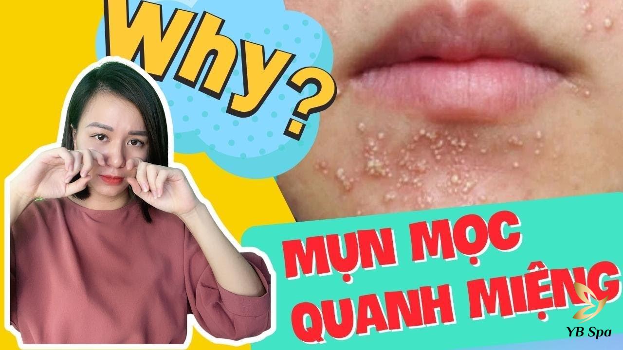 Mụn Mọc Quanh Miệng Do đâu? Cách điều Trị Hiệu Quả
